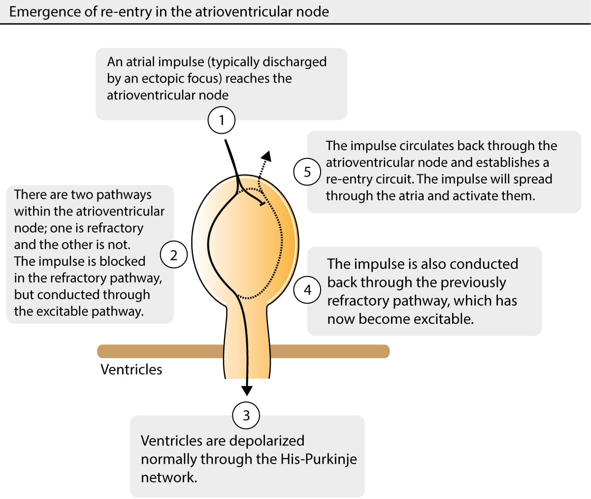 Figure 1. Mechanism leading to AVNRT. – ECG learning
