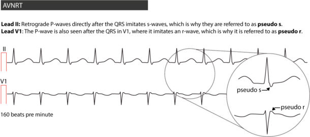 Atrioventricular nodal reentry tachycardia (AVNRT): ECG features ...
