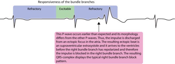 Aberrant ventricular conduction (aberrancy, aberration) – The ...