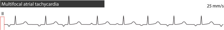 Ectopic atrial rhythm (EAT), atrial tachycardia (AT) & multifocal ...