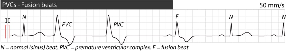 Premature ventricular complexes (premature ventricular beats, premature ...