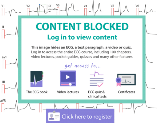 Aberrant ventricular conduction (aberrancy, aberration ...
