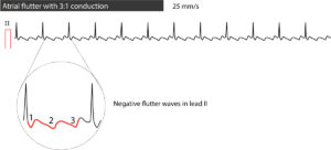 Atrial flutter: classification, causes, ECG diagnosis & management ...