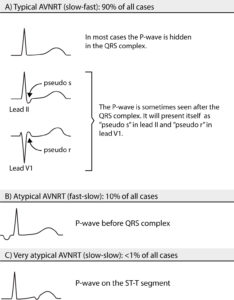 Hypernatremia Ecg 1000+ Images About Nursing: NCLEX On Pinterest ...