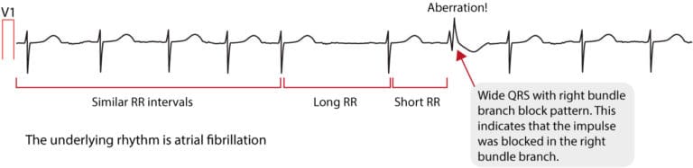 Figure 4. ECG showing Ashman's phenomenon during atrial fibrillation ...