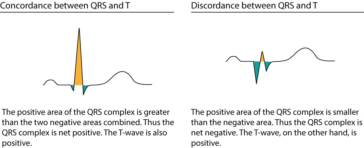 Figure 3. Concordant and discordant T-waves. – ECG learning