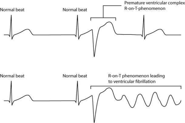 r-on-t – ECG learning