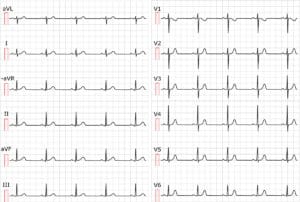 Sinus rhythm: physiology, ECG criteria & clinical implications – The ...