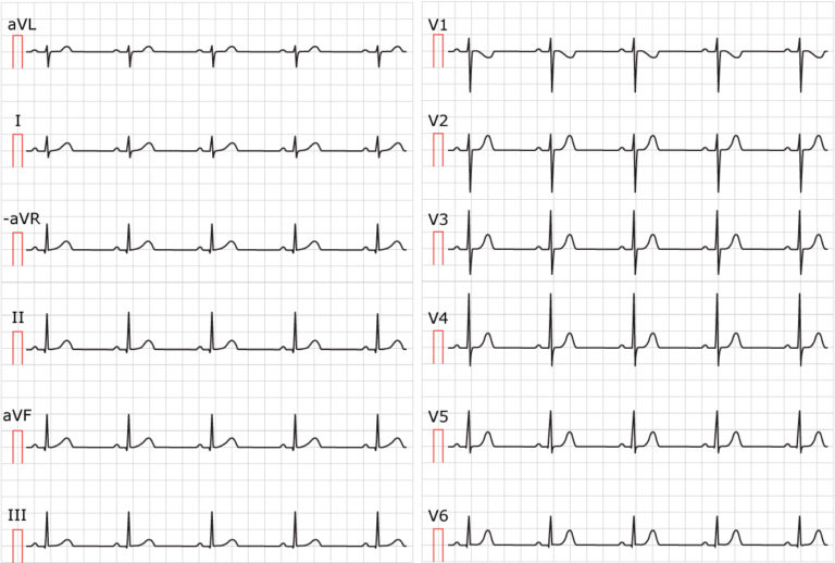 Sinus rhythm: physiology, ECG criteria & clinical implications – The ...