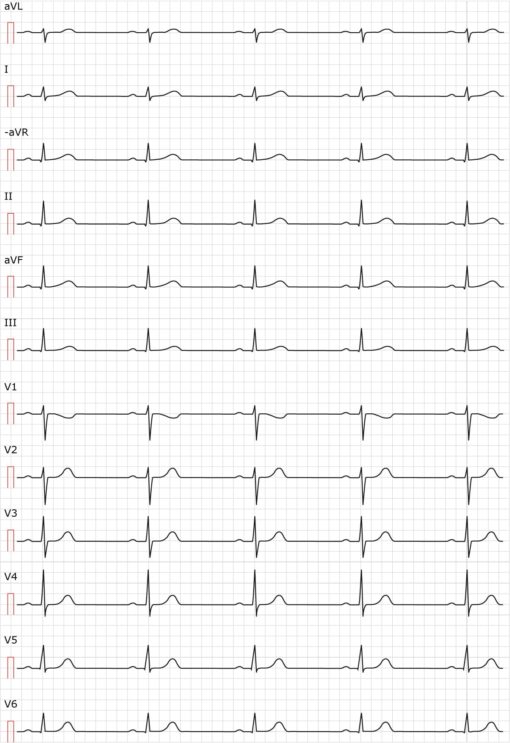 Sinus rhythm: physiology, ECG criteria & clinical implications – The ...
