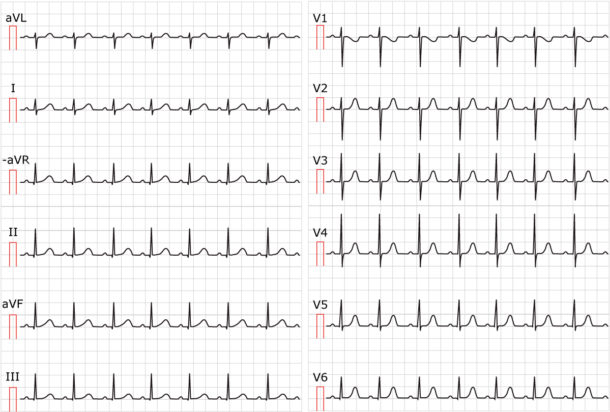 Sinus tachycardia & Inappropriate sinus tachycardia – The Cardiovascular