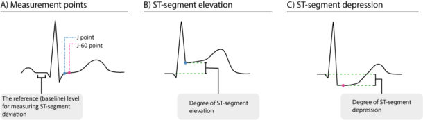 Figure 34. ST-segment deviation – ECG learning