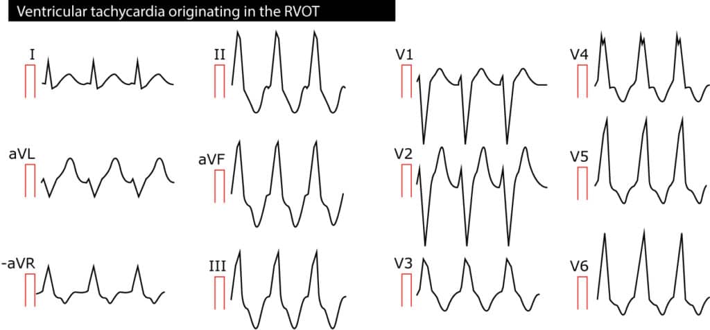 Figure 2. Ventricular tachycardia originating in the right ventricular ...