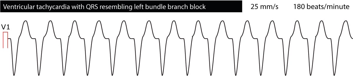 Figure 5. Ventricular tachycardia with left bundle branch block ...
