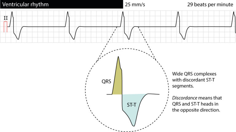 Ventricular rhythm and accelerated ventricular rhythm (idioventricular ...