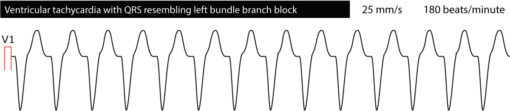 Ventriculaire tachycardie (VT): ECG-criteria, oorzaken, classificatie ...
