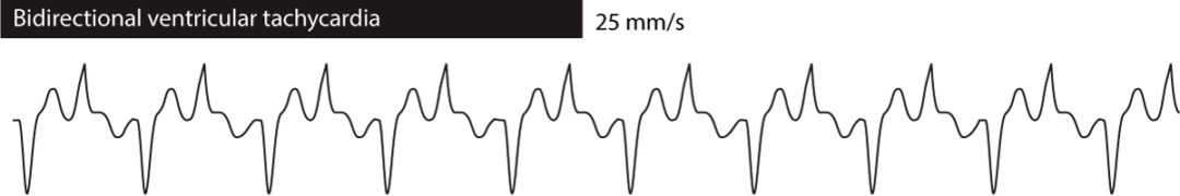 Ventricular tachycardia (VT): ECG criteria, causes, classification ...