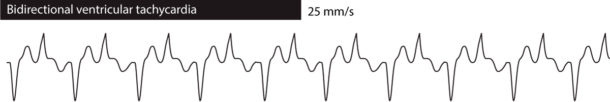 Ventricular tachycardia (VT): ECG criteria, causes, classification ...