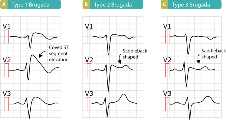 ST segment elevation in acute myocardial ischemia and differential diagnoses – The Cardiovascular