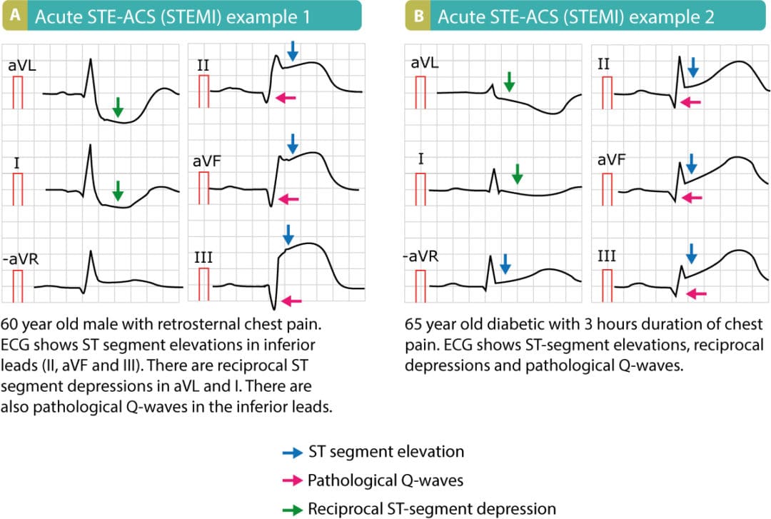 The ultimate ECG book & course: learn ECG interpretation, videos, test ...