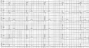 Early repolarization pattern on ECG (early repolarization syndrome ...