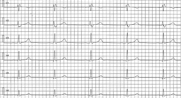 Early repolarization pattern on ECG (early repolarization syndrome ...