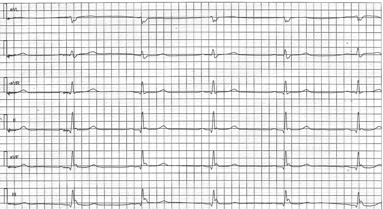 Early repolarization pattern on ECG (early repolarization syndrome ...