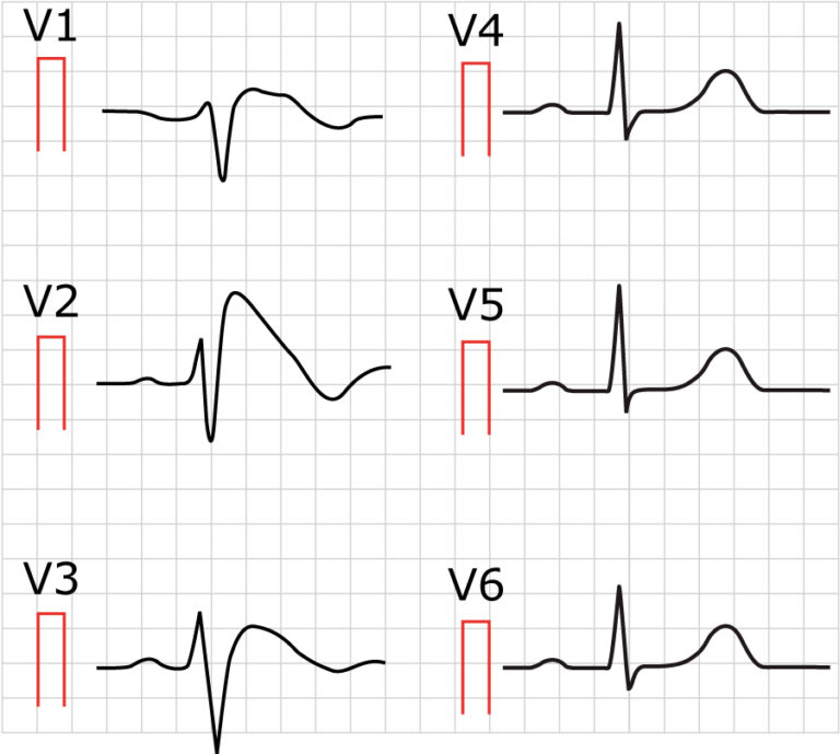 ECG J wave syndromes: hypothermia, early repolarization, hypercalcemia & Brugada syndrome – The ...