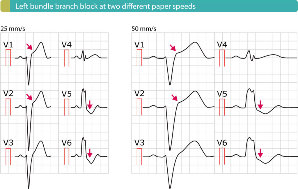 ST segment elevation in acute myocardial ischemia and differential ...