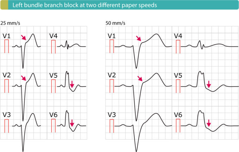 ST elevation myocardial infarction (STEMI) without ST elevations on 12 ...
