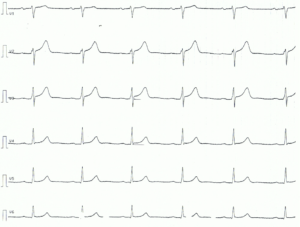 Pericardite, miocardite e perimiocardite: ECG, criteri e trattamento ...