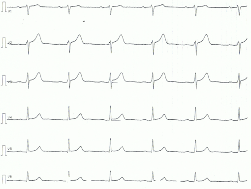 Perikardit, myokardit och perimyokardit: EKG, kriterier och behandling ...