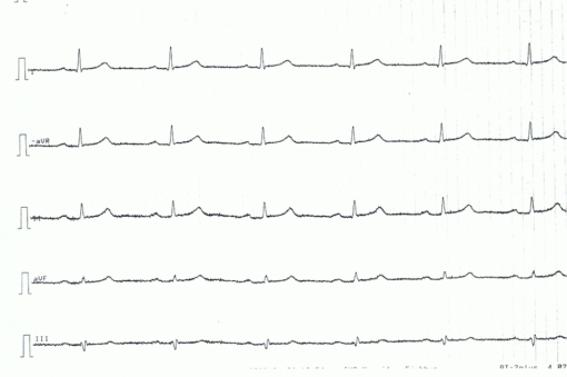 Perikardit, myokardit och perimyokardit: EKG, kriterier och behandling ...