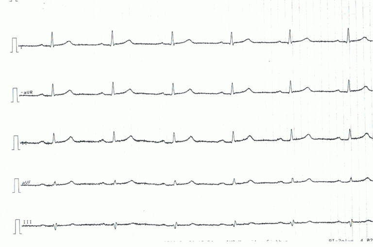 Pericarditis, myocarditis & perimyocarditis: ECG, criteria & treatment ...