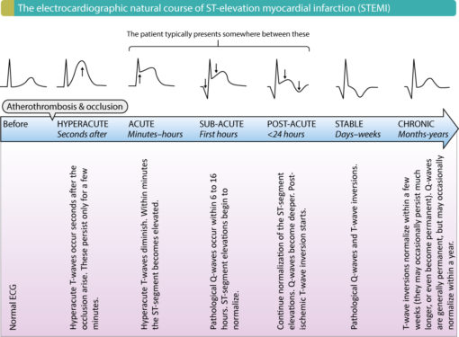 The ECG in assessment of myocardial reperfusion – The Cardiovascular