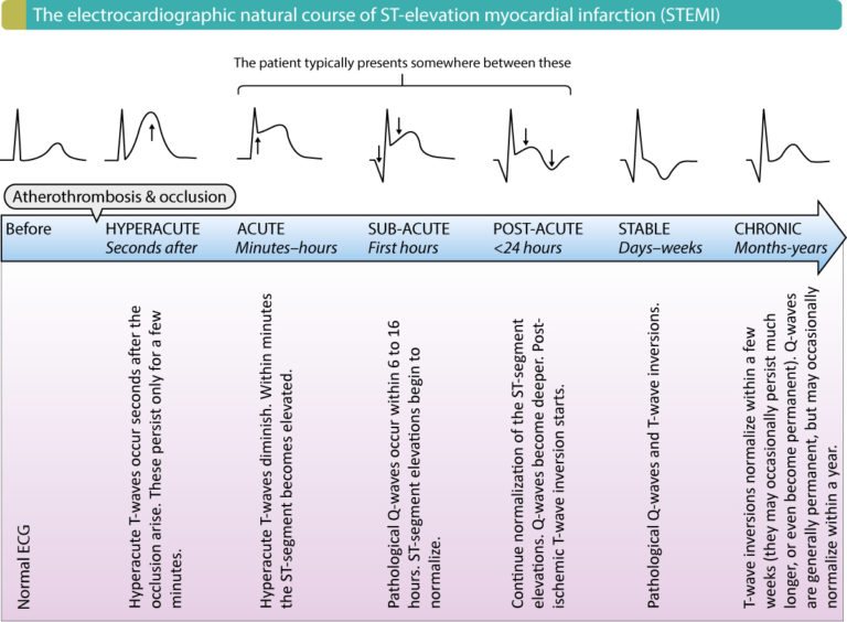 The ECG in assessment of myocardial reperfusion – The Cardiovascular