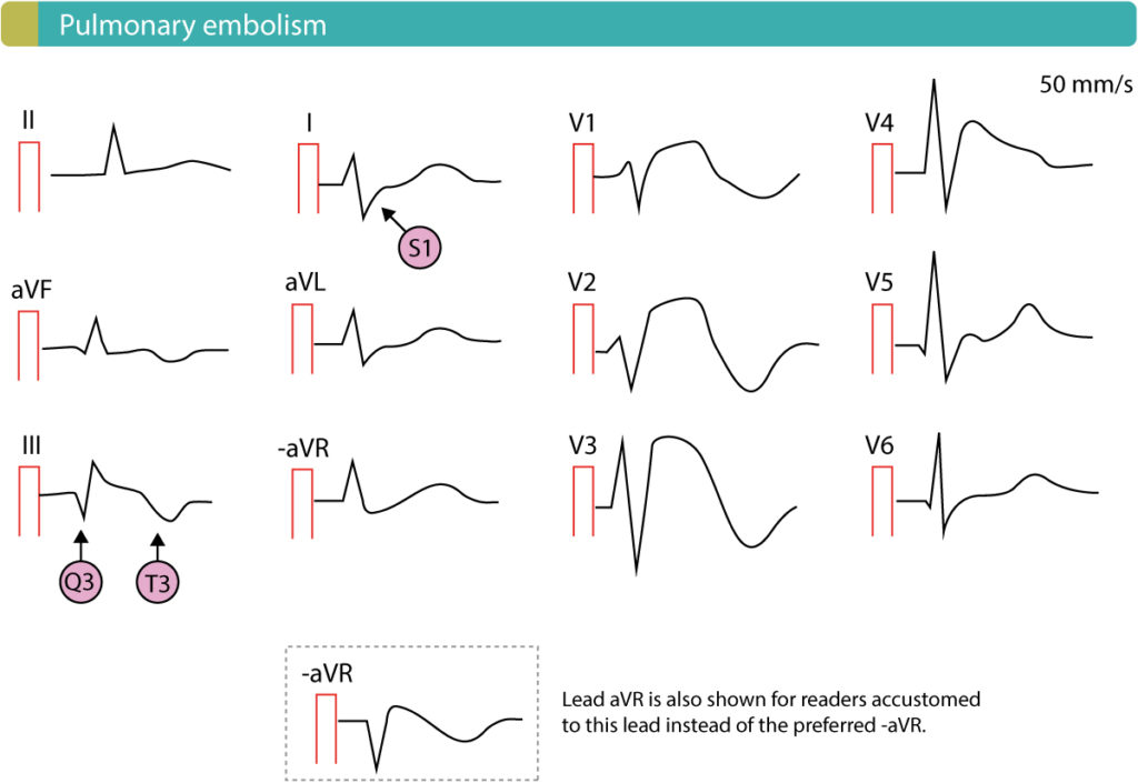 ST segment elevation in acute myocardial ischemia and differential ...