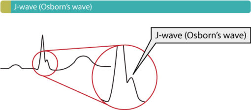 ST segment elevation in acute myocardial ischemia and differential ...