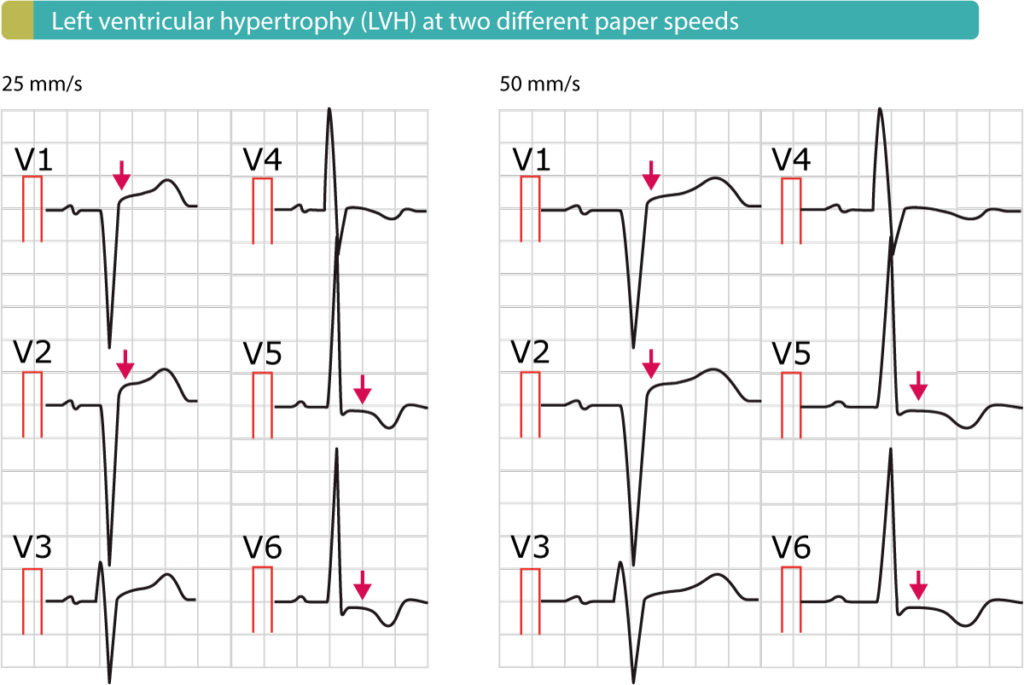 ST segment elevation in acute myocardial ischemia and differential ...
