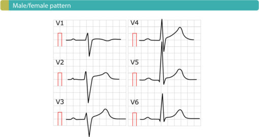 ST segment elevation in acute myocardial ischemia and differential ...