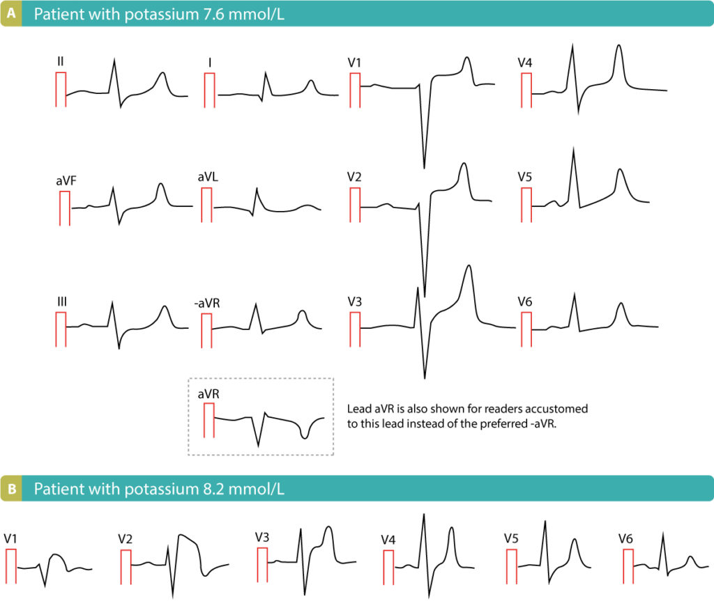 ST segment elevation in acute myocardial ischemia and differential ...