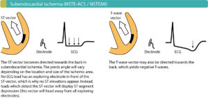 ECG in myocardial ischemia: ischemic changes in the ST segment & T-wave ...