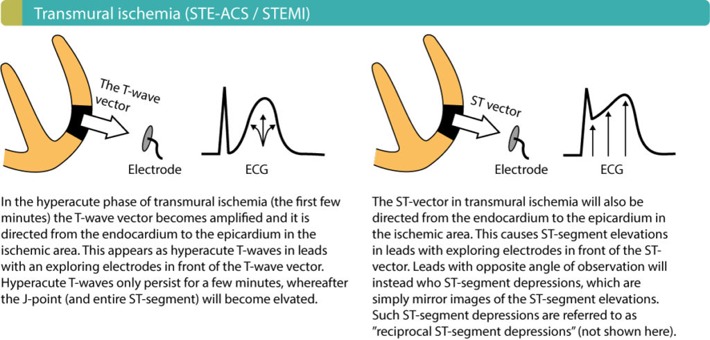 ECG in myocardial ischemia: ischemic changes in the ST segment & T-wave ...