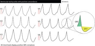Ventricular tachycardia (VT): ECG criteria, causes, classification ...