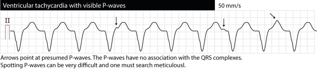 Ventricular tachycardia (VT): ECG criteria, causes, classification ...