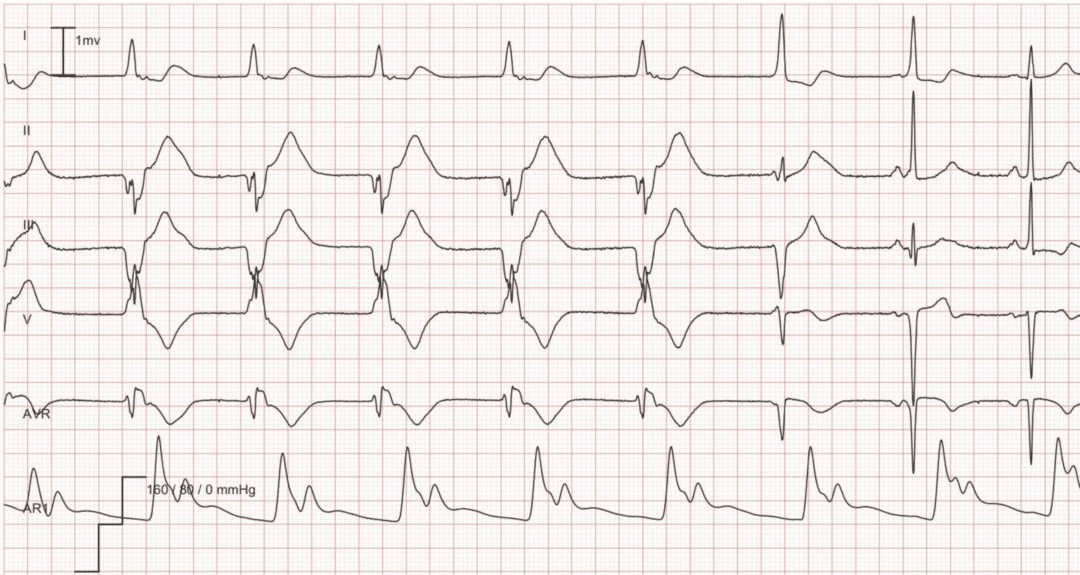 Ventricular rhythm and accelerated ventricular rhythm (idioventricular ...