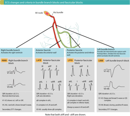 Intraventricular conduction delay: bundle branch blocks & fascicular ...