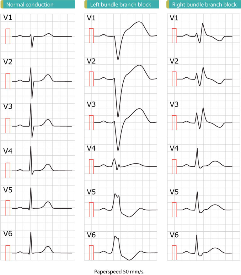 Left bundle branch block (LBBB): ECG criteria, causes, management – The ...