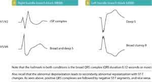 Left bundle branch block (LBBB): ECG criteria, causes, management – The ...