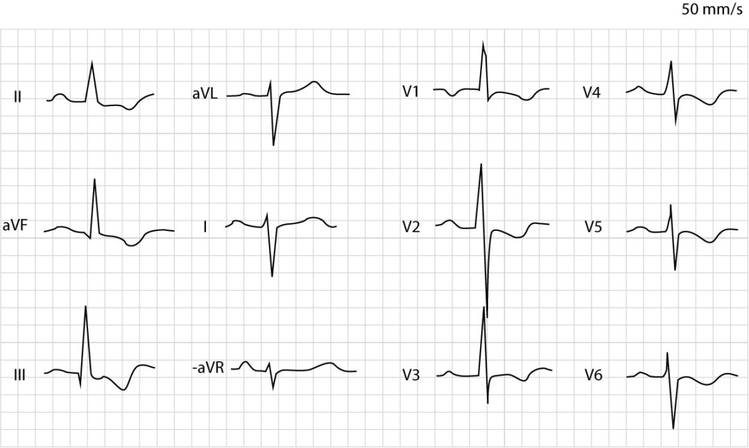 Posterior acute myocardial infarction (STEMI)